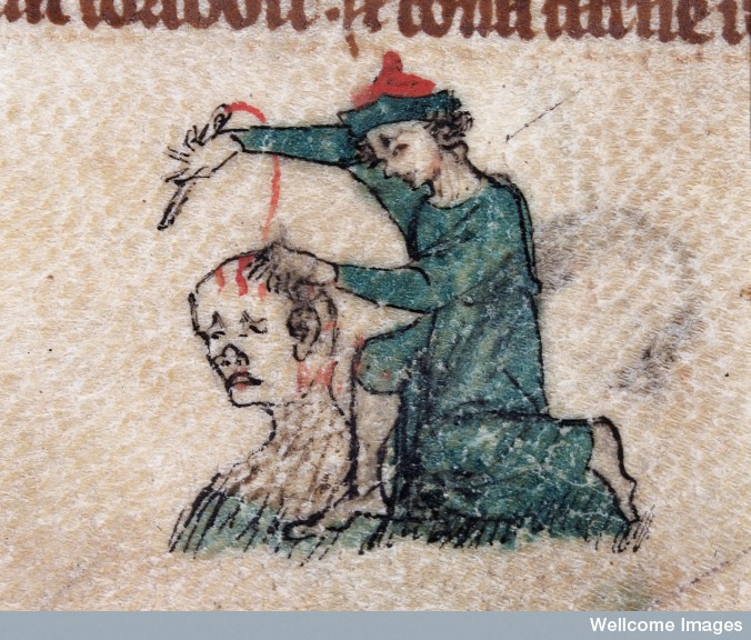 Terrifying medieval medical procedures that will make your toes curl