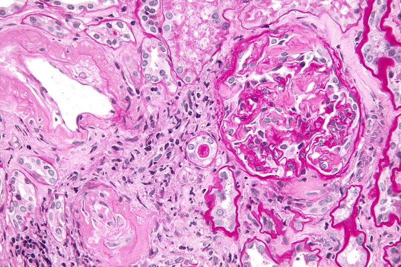 What is amyloidosis? The rare genetic disease that killed Martin McGuinness