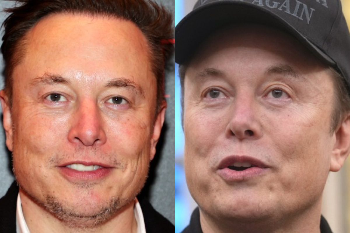 Elon Musk 'Mounjaro' Face Side Effects and Potential $172,000 Plastic ...